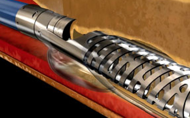 Lights, Camera, Action: New Catheter Lets Doctors See Inside Arteries ...