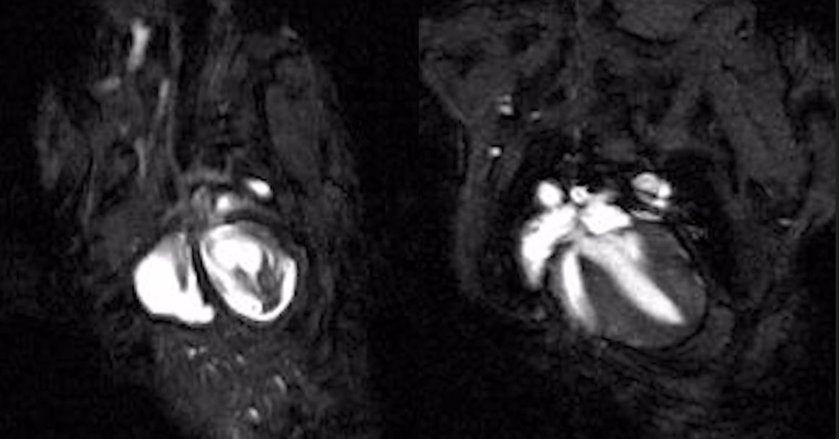 Could Gene Therapy Treat a Deadly Heart Condition That Targets Young ...