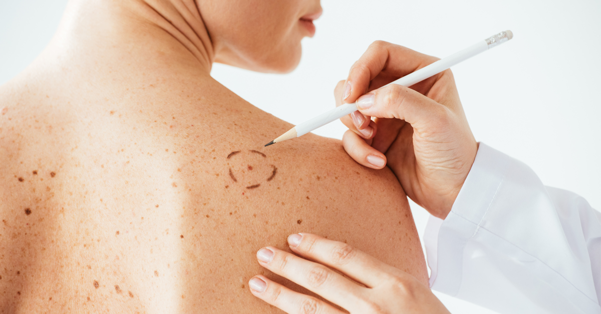 Naturally Occurring Molecule May Help Outsmart Melanoma